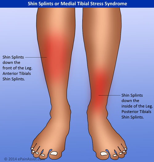 Shin Splints Shinbone Pain Treatment Brace Shin Splints Shinbone Pain Treatment Brace