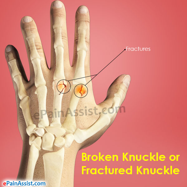 How To Tell If Your Hand Is Broken Or Just Bruised A Broken Toe Or How To Tell If Your Hand Is Broken Or Just Bruised A Broken Toe Or