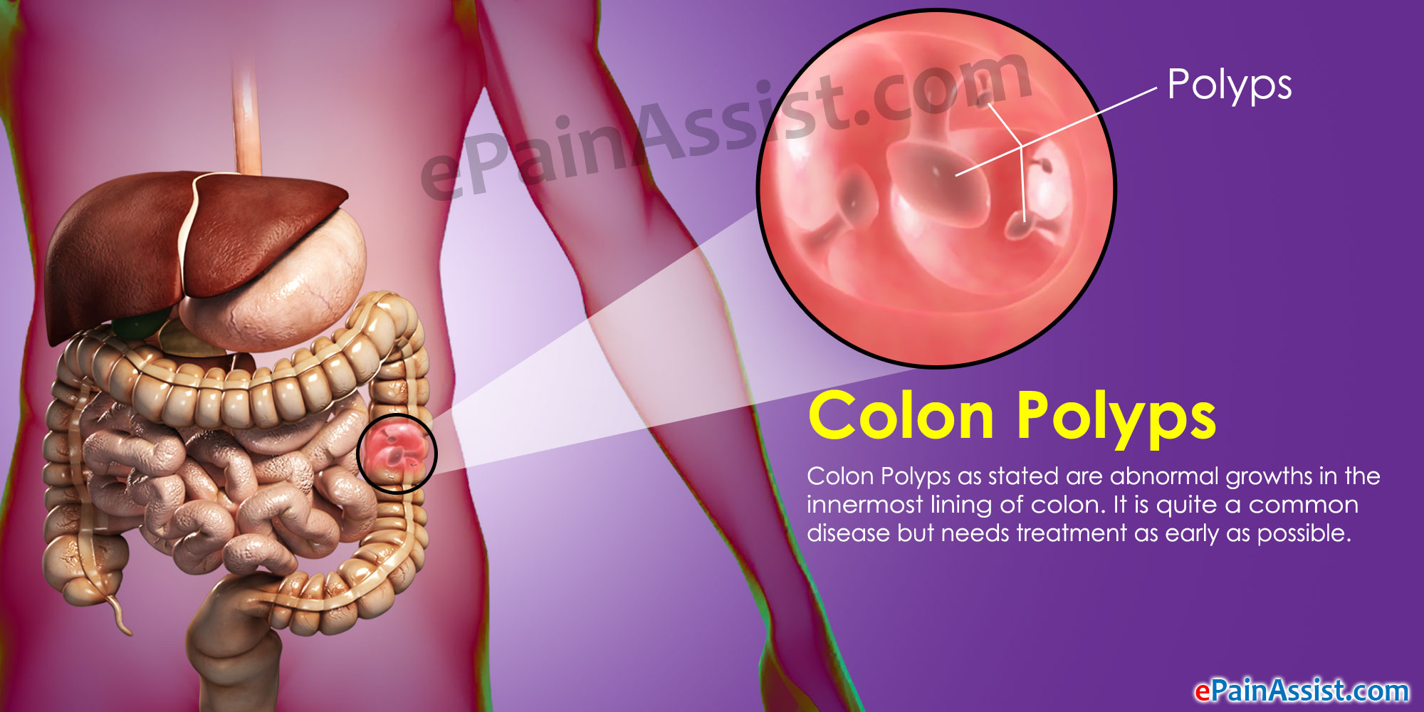 Colon Polyps Treatment Prevention Causes Symptoms Facts