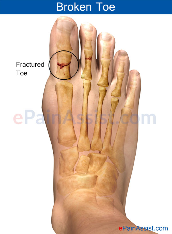 Broken Toe Or Fractured Toe Treatment Symptoms Recovery Prognosis