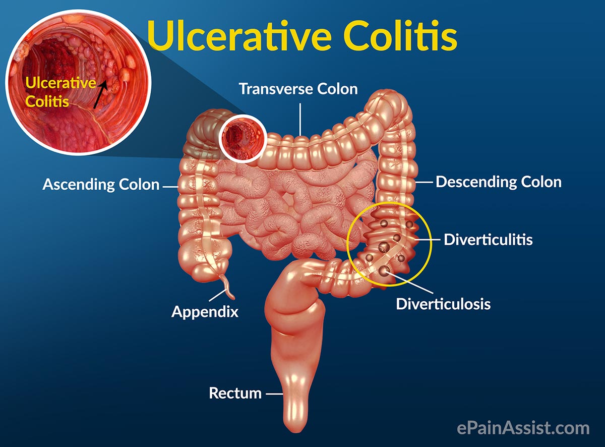 Colitis Diagnosis And Healing Healer In Mirror Part 5