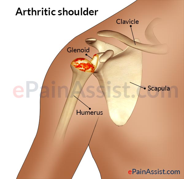 Diagnosis Of Shoulder Joint Pain Symptoms Physical Exam