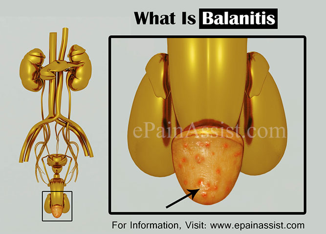 What Is Balanitis Know Its Treatment Causes Symptoms Home Remedies What Is Balanitis Know Its Treatment Causes Symptoms Home Remedies
