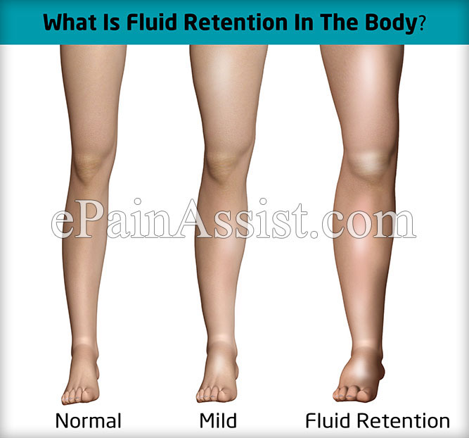 What Is Fluid Retention In The Body How Is It Treated 
