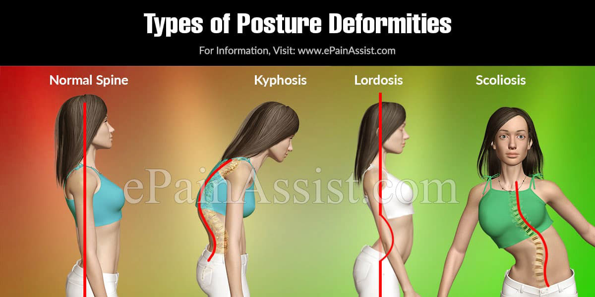 What Is Posture Know The Types Of Posture Deformities Its Causes