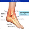 Ankle Injuries|Dislocation|impingement|Sprain|fracture|peroneal tendon