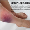 Lower Leg Injuries | Pulled Calf Muscles | Page 5