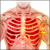 Chest Pain Information Center|Chest Tightness|Angina|Breast Cancer ...