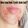 Acne Center: Blackheads, Cystic Acne, Whiteheads, Scarring, Pimples and ...