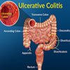 Cecal Volvulus: Treatment, Diet, Causes, Symptoms, Diagnosis