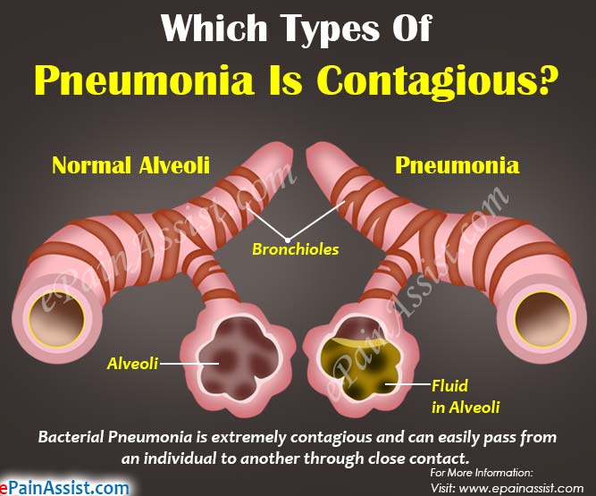 Which Type Of Pneumonia Is Contagious How Long Is Pneumonia Contagious 