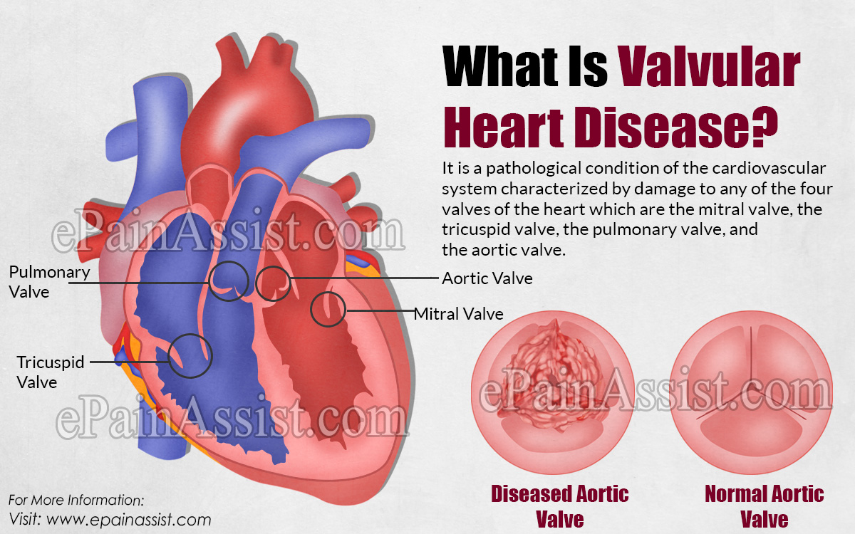 What Is Valvular Heart Disease Causes Symptoms Treatment