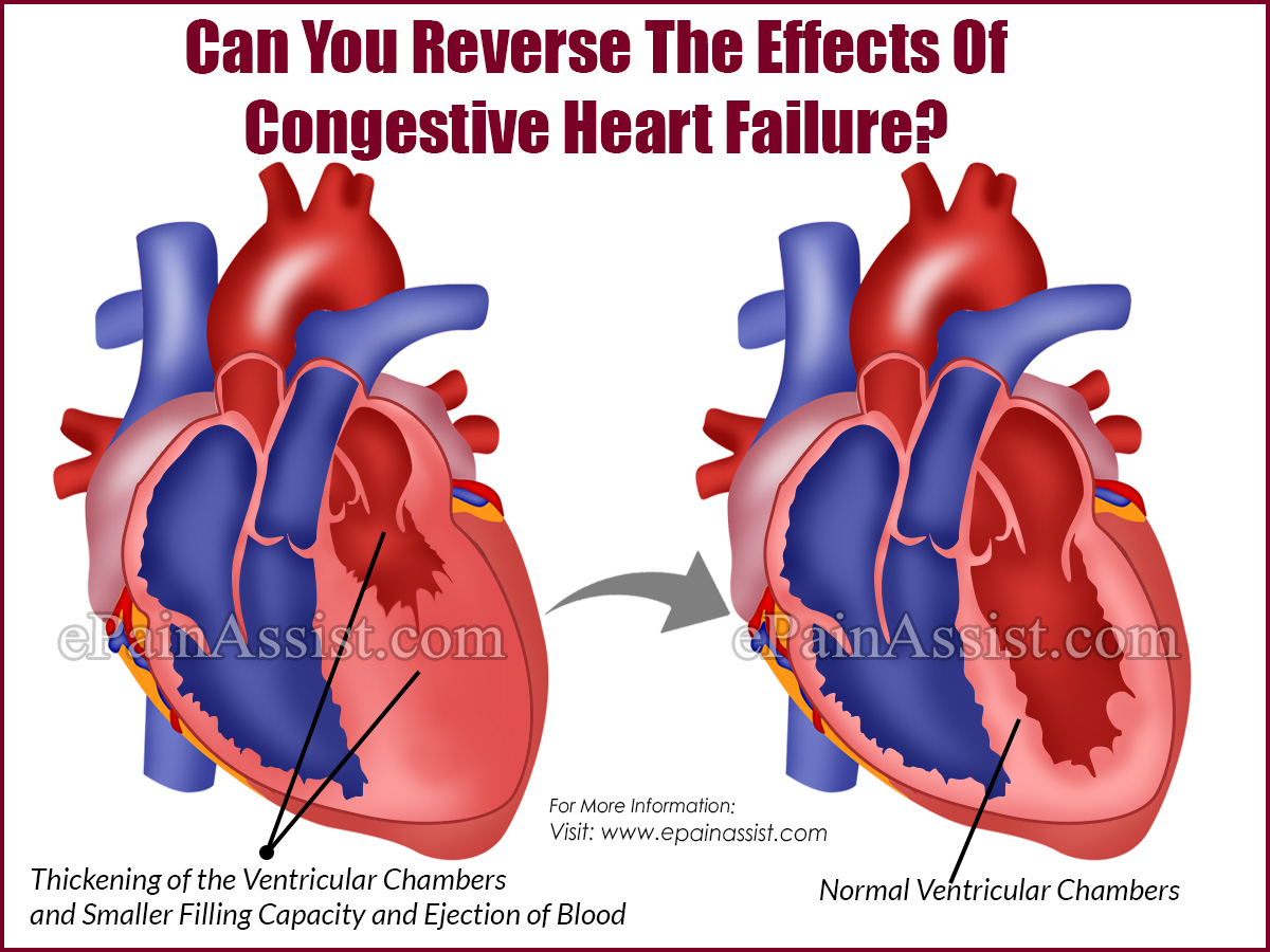 Can You Reverse The Effects Of Congestive Heart Failure 