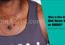 How to Get Rid of Blue Veins on Chest?