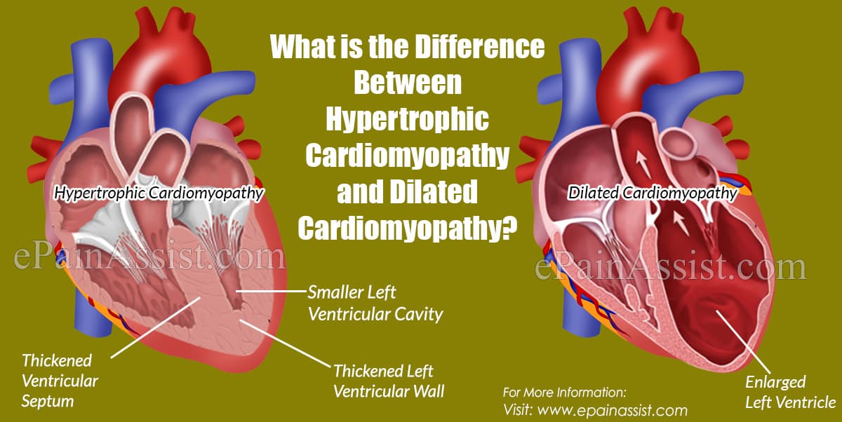 What Is The Difference Between Hypertrophic Cardiomyopathy And Dilated What Is The Difference Between Hypertrophic Cardiomyopathy And Dilated