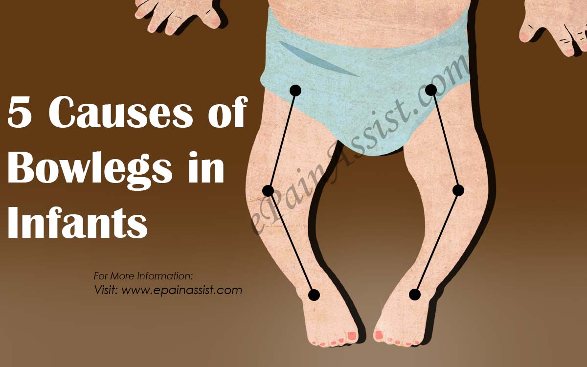 5 Causes Of Bowlegs In Infants