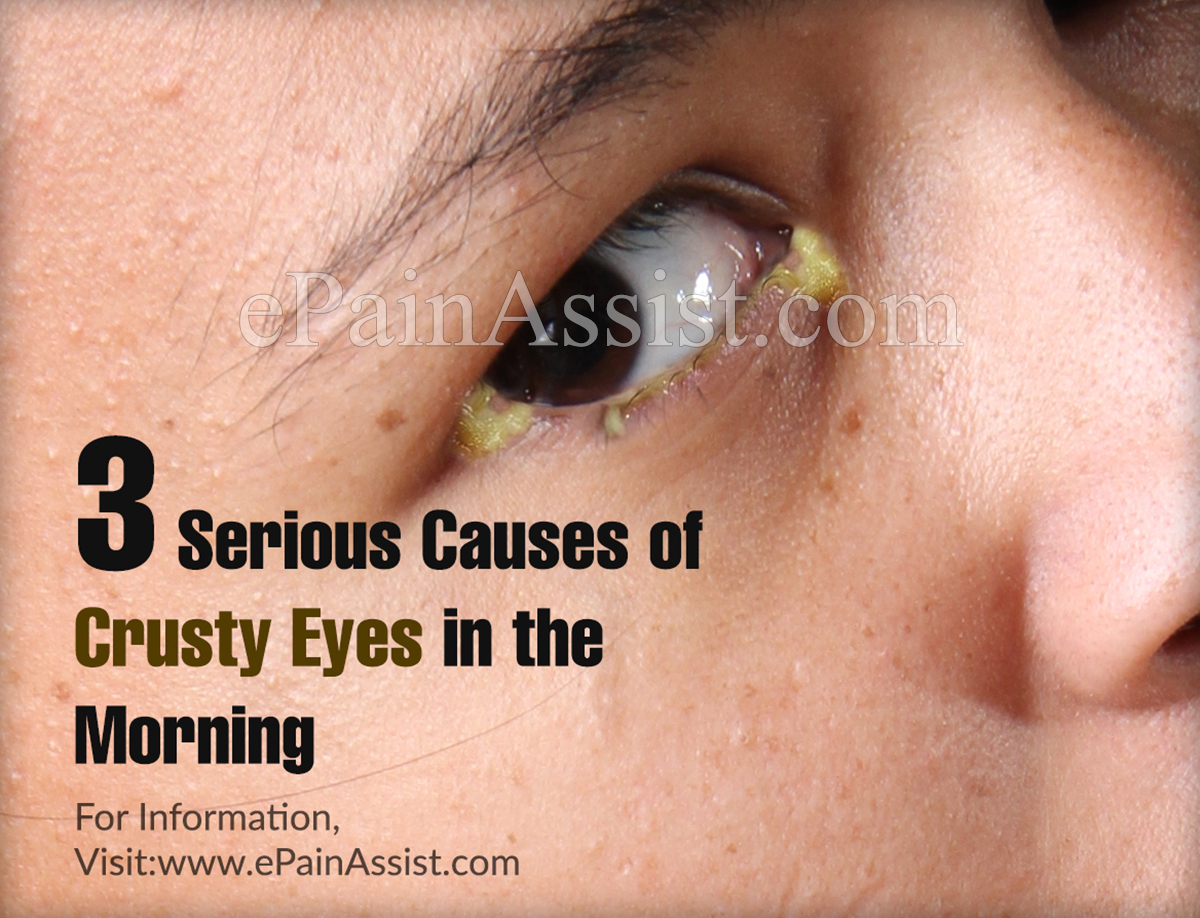 3 Serious Causes Of Crusty Eyes In The Morning 3 Serious Causes Of Crusty Eyes In The Morning