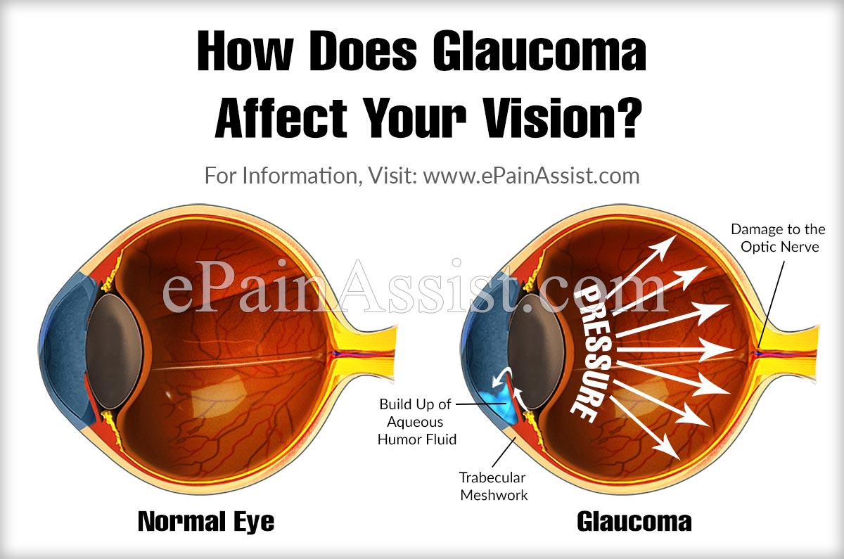 How Does Glaucoma Affect Your Vision 