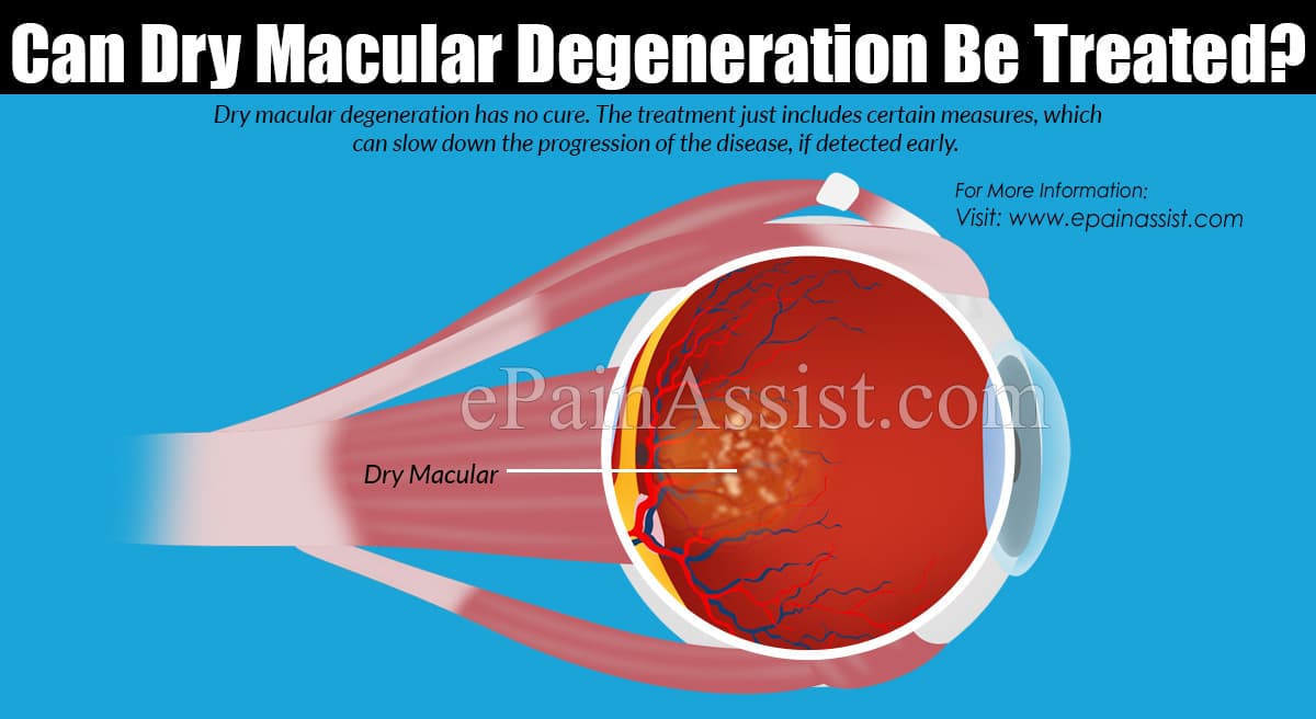 Can Dry Macular Degeneration Be Treated 