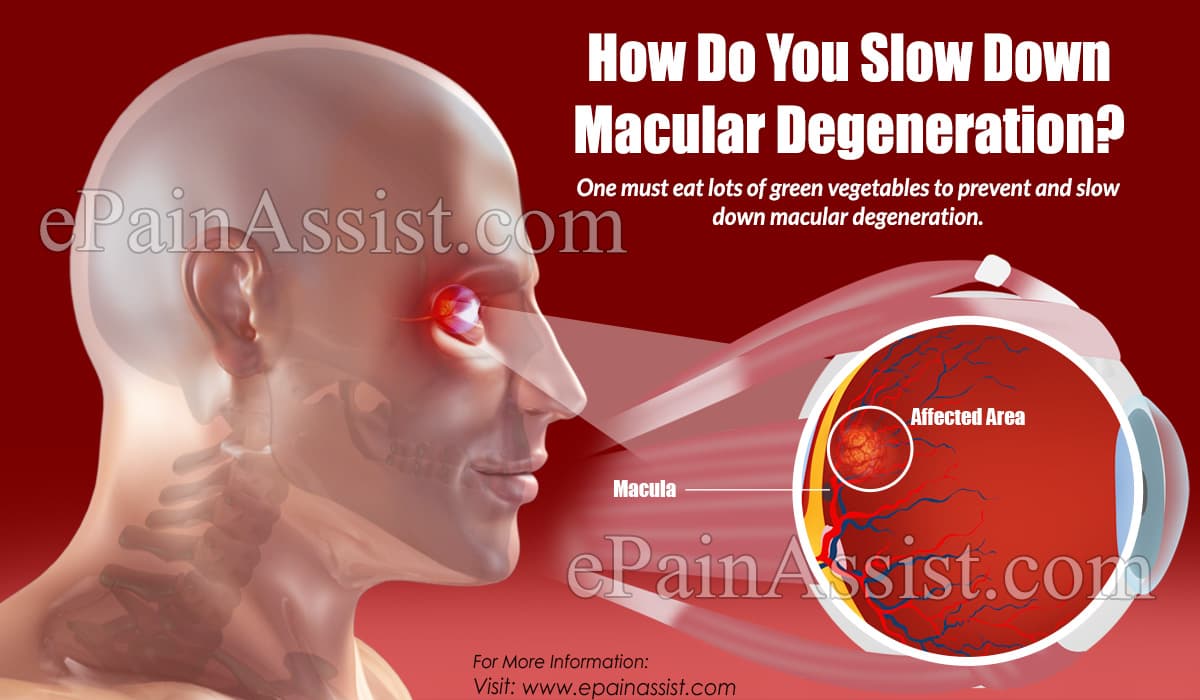 How Do You Slow Down Macular Degeneration 