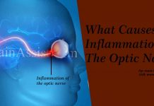 Optic Neuritis or Retrobulbar Neuritis|Causes|Signs|Treatment|Epidemiology