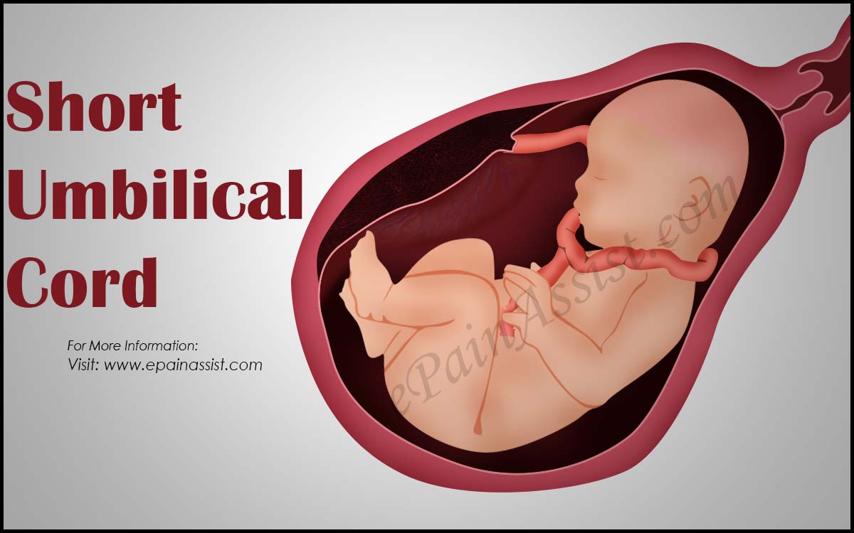 Short Umbilical Cord Causes Symptoms Risk Factors Treatment