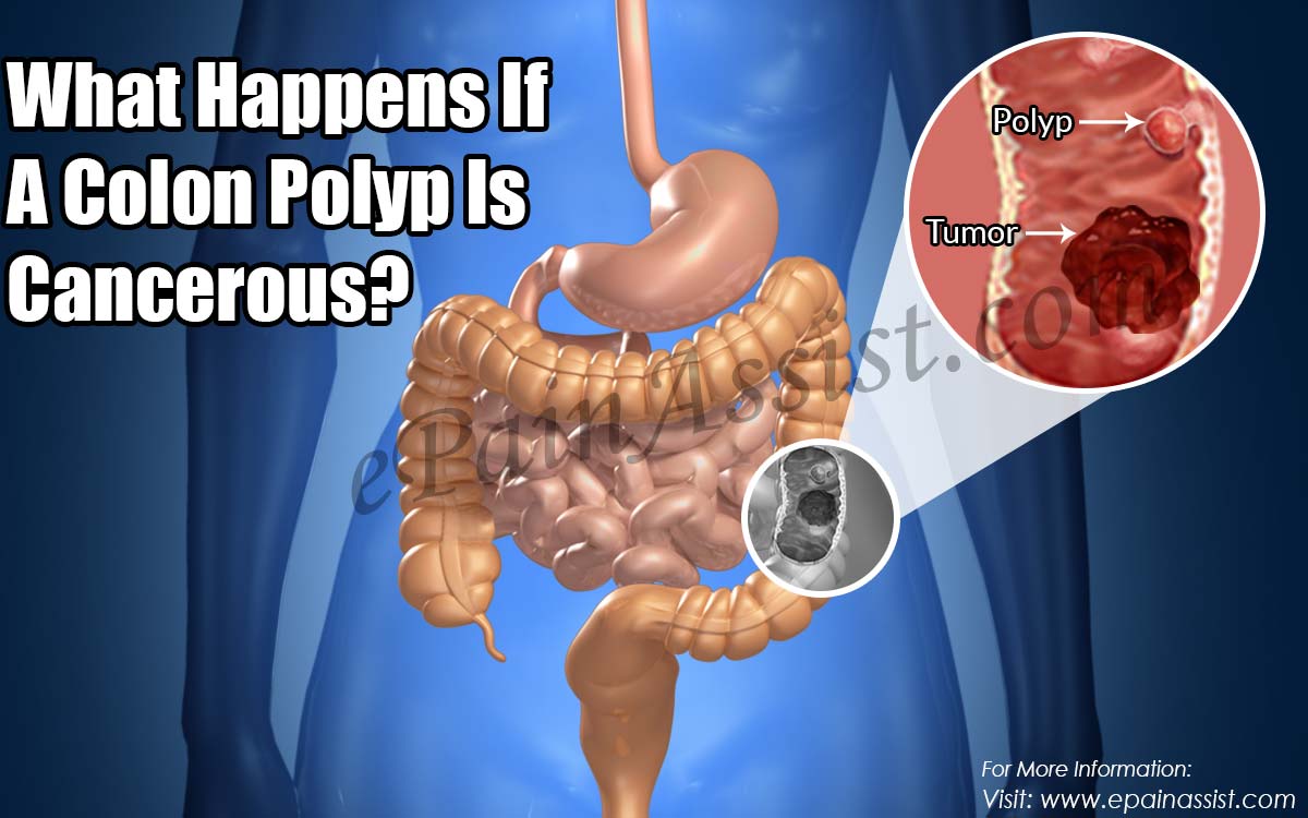 What Happens If A Colon Polyp Is Cancerous 