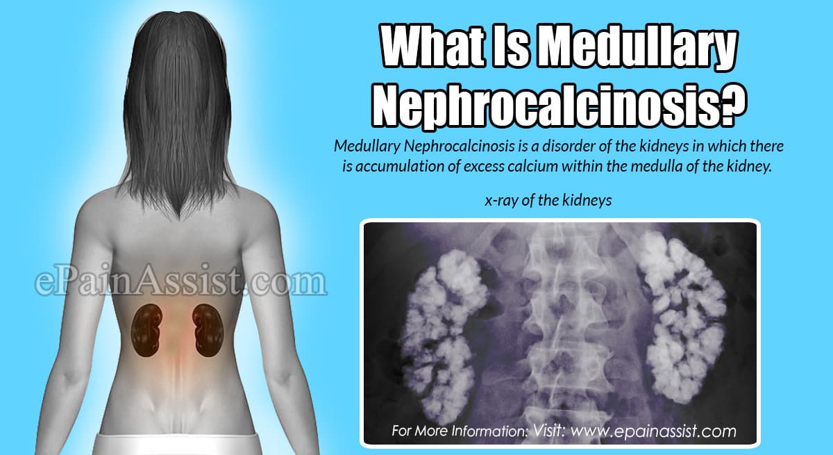 Medullary Nephrocalcinosis Causes Symptoms Treatment Medullary Nephrocalcinosis Causes Symptoms Treatment