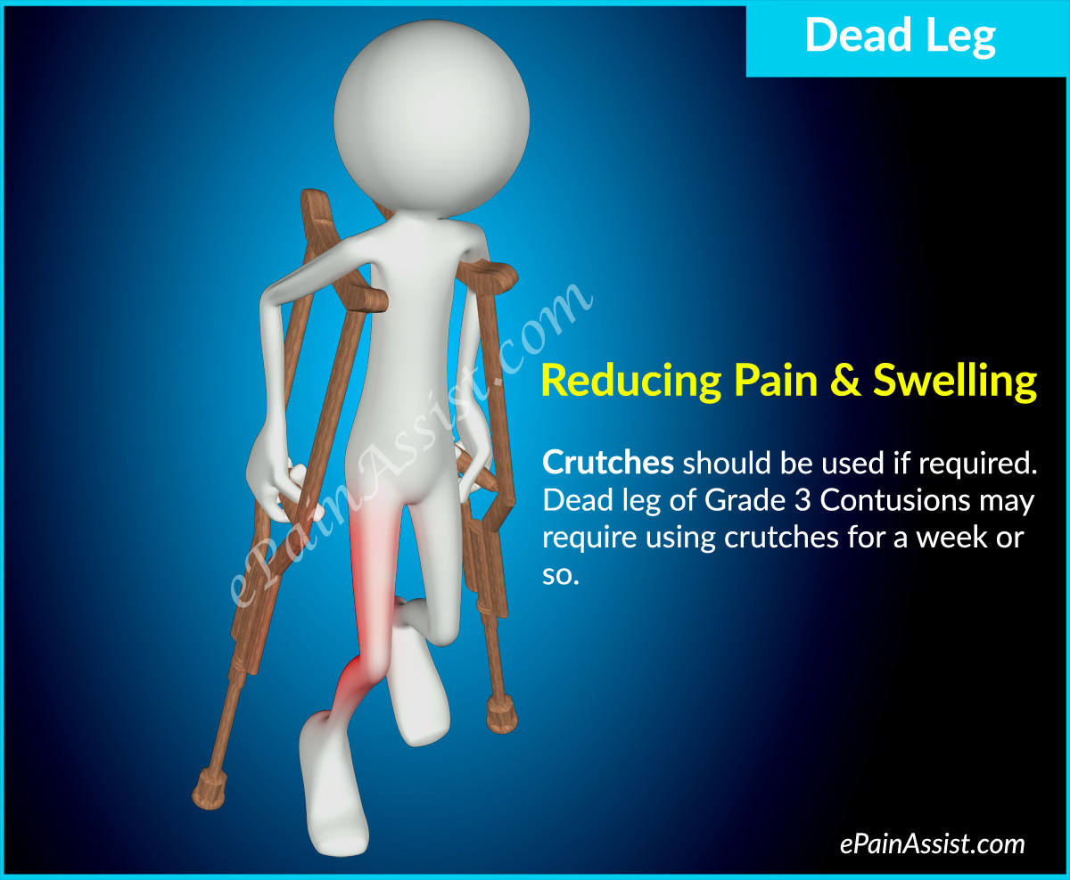 Dead Leg|Treatment|Rehab|Exercises|Recovery|Prevention