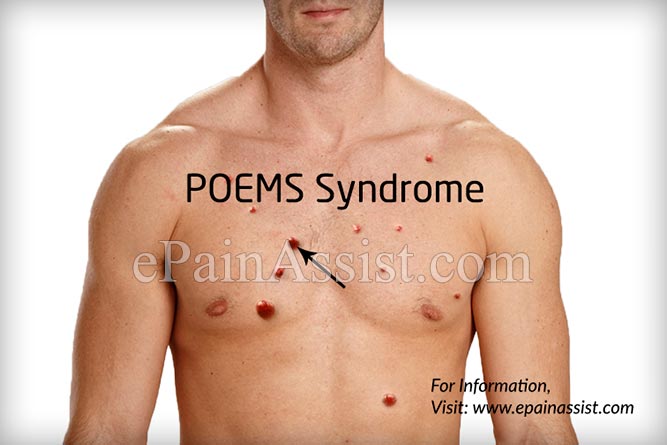 POEMS Syndrome|Causes|Symptoms|Treatment|Prognosis|Survival Rate