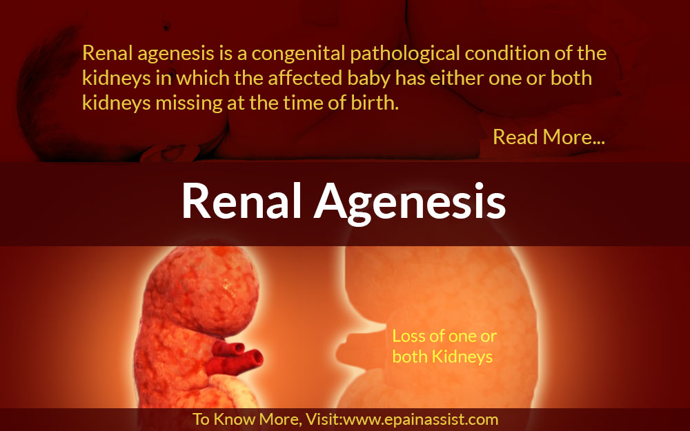 Renal Agenesis: Treatment, Prevention, Causes, Symptoms