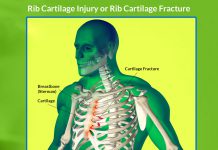 Rib Pain Information Center|Bruised Ribs|Rib Cartilage Injury|Fracture