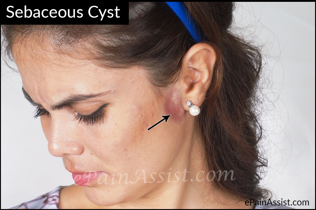 Sebaceous Cyst|Causes|Symptoms|Investigations|Treatment-Wide Excision ...