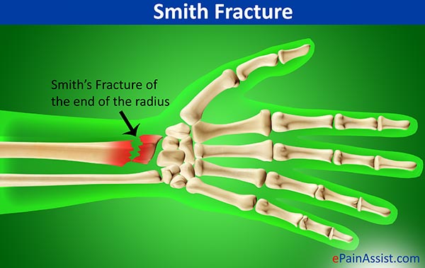 Smith Fracture|Treatment|Exercise|Causes|Symptoms|Types