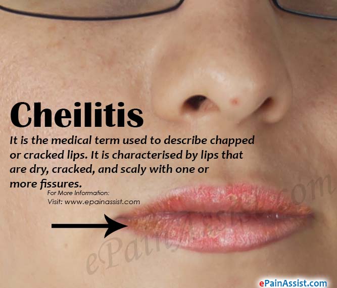 Cheilitis | Types | Causes | Symptoms | Treatment | Diagnosis