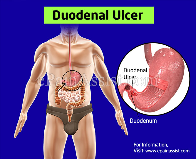 What Causes Duodenal Ulcer?