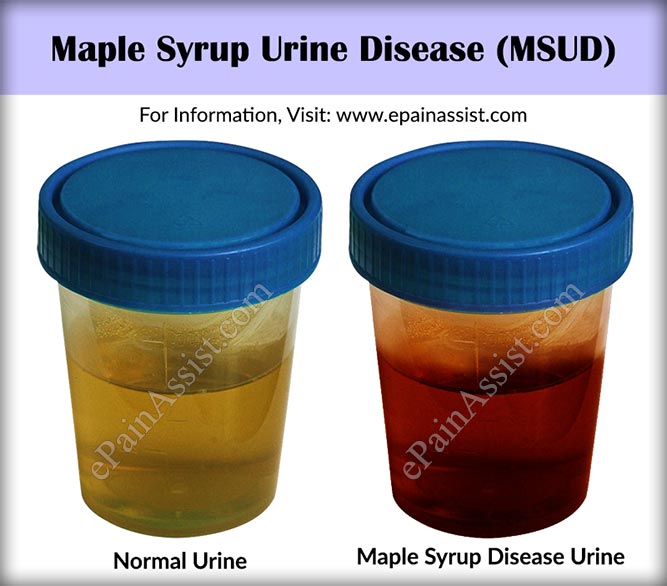 Maple Syrup Urine Disease (MSUD): Treatment, Nutritional Therapy