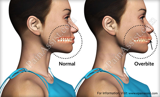 What is an Overbite|Types|Causes|Treatment|Problems of Overbite