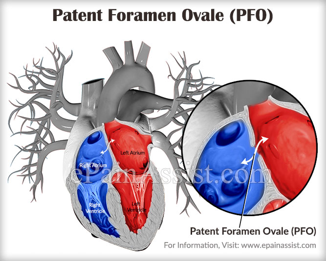 What is Patent Foramen Ovale (PFO)|Causes|Symptoms|Treatment|Diagnosis