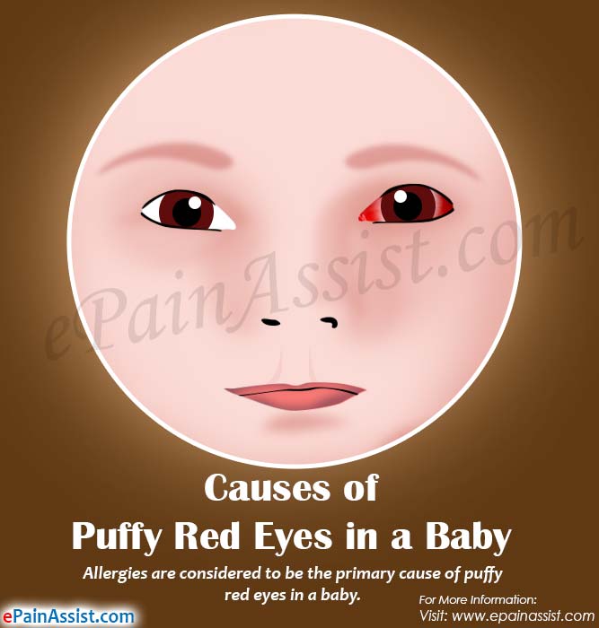 Causes of Puffy Red Eyes in a Baby & Ways to Get Rid of It