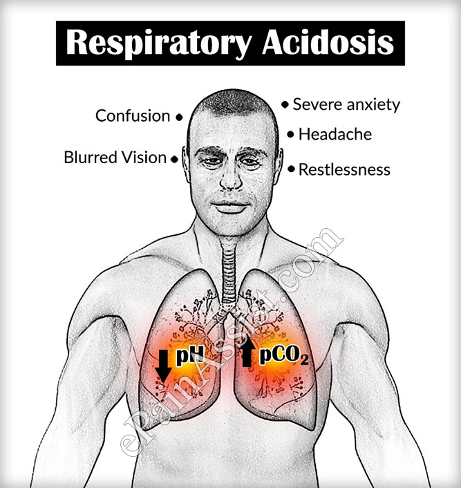 Respiratory Acidosis|Types|Causes|Symptoms|Treatment