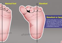 Foot Deformities Information Center