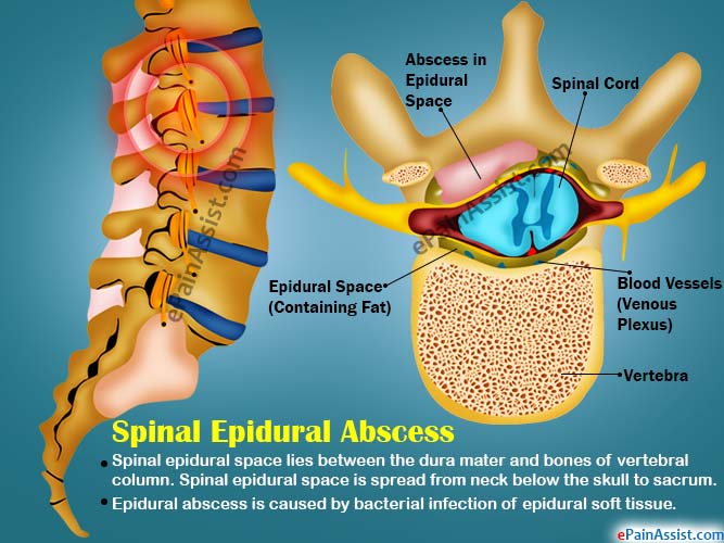 Spinal Epidural Abscess: Treatment, Symptoms, Causes