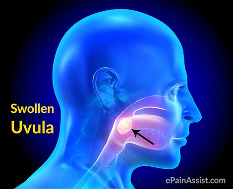 Swollen Uvula or Uvulitis|Causes|Treatment|Home Remedies|Symptoms ...