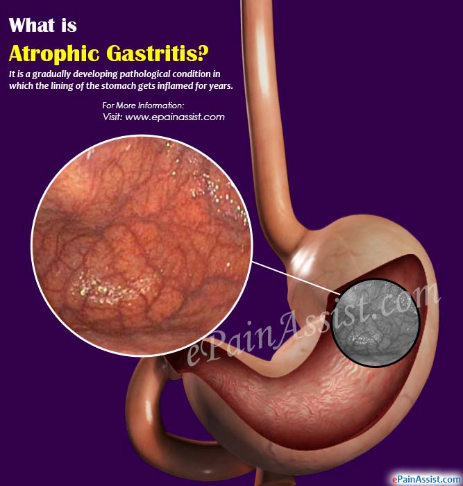 Atrophic Gastritis|Causes|Symptoms|Treatment|Diagnosis