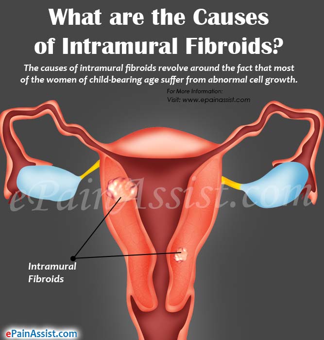 What are Intramural Fibroids, Know its Causes, Symptoms, Treatment, Surgery