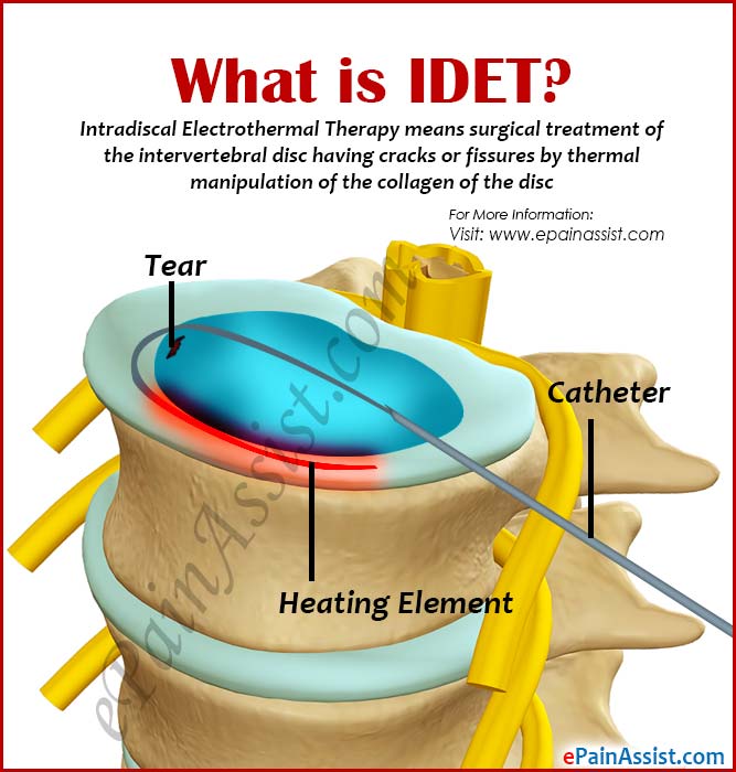 What is IDET|Indications|Procedure|Recovery Period|Contraindications ...
