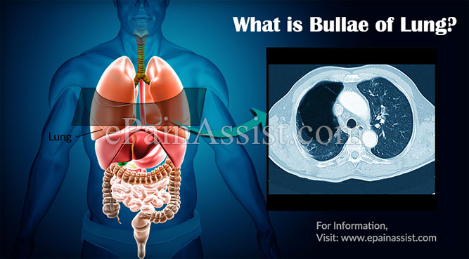 What is Bullae of Lung & How is it Treated?