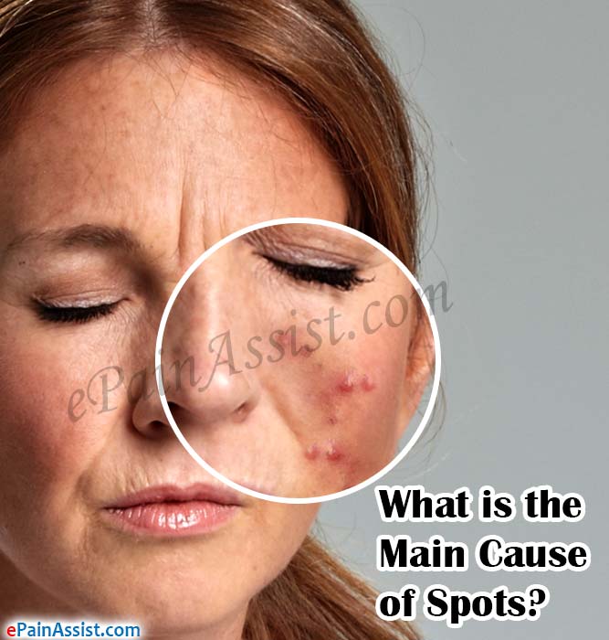 What is the Main Cause of Spots?