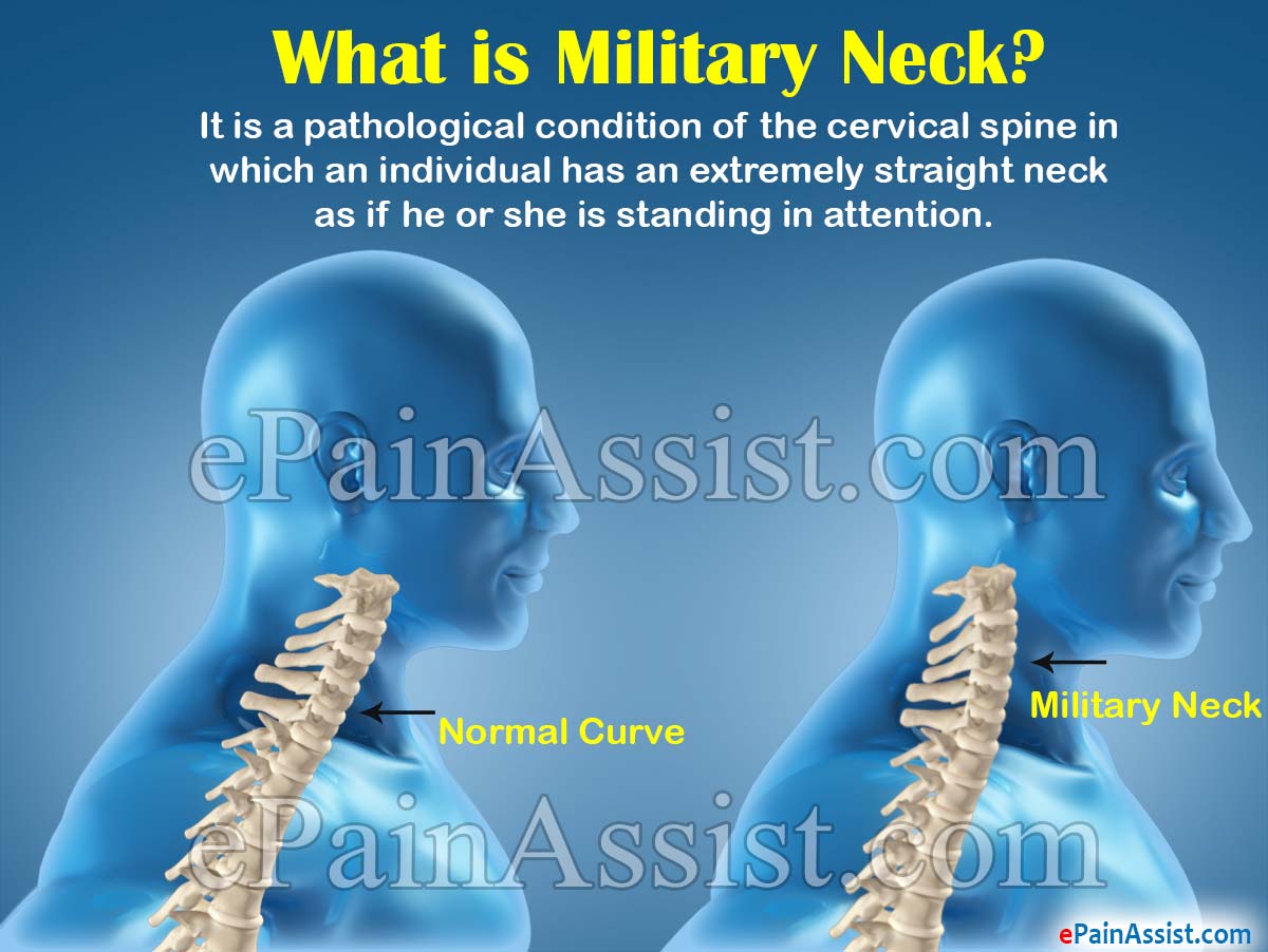 Military Neck|Causes|Symptoms|Treatment|Exercise